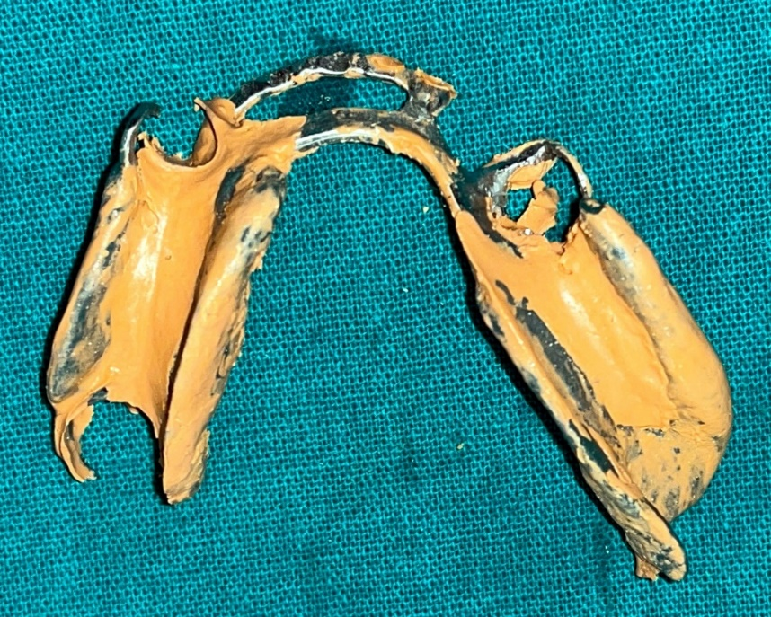 Revolutionizing Rehabilitation: Prosthodontic Management of Distal Extension Using Cobalt ...